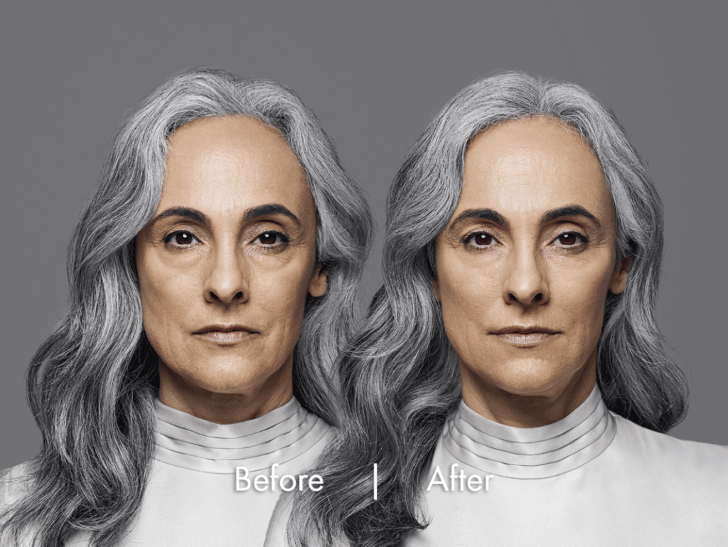 RHA Fillers Before and After Photo Gallery |Avail Aesthetics