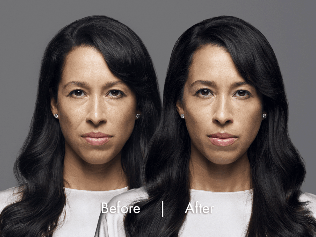 RHA Fillers Before and After Photo Gallery |Avail Aesthetics